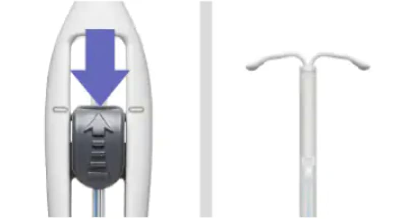 The Bayer EvoInserter® | Bayer IUD (intrauterine devices)